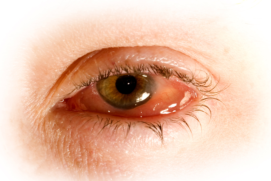 Pink Eye All You Need To Know In 6 Photos